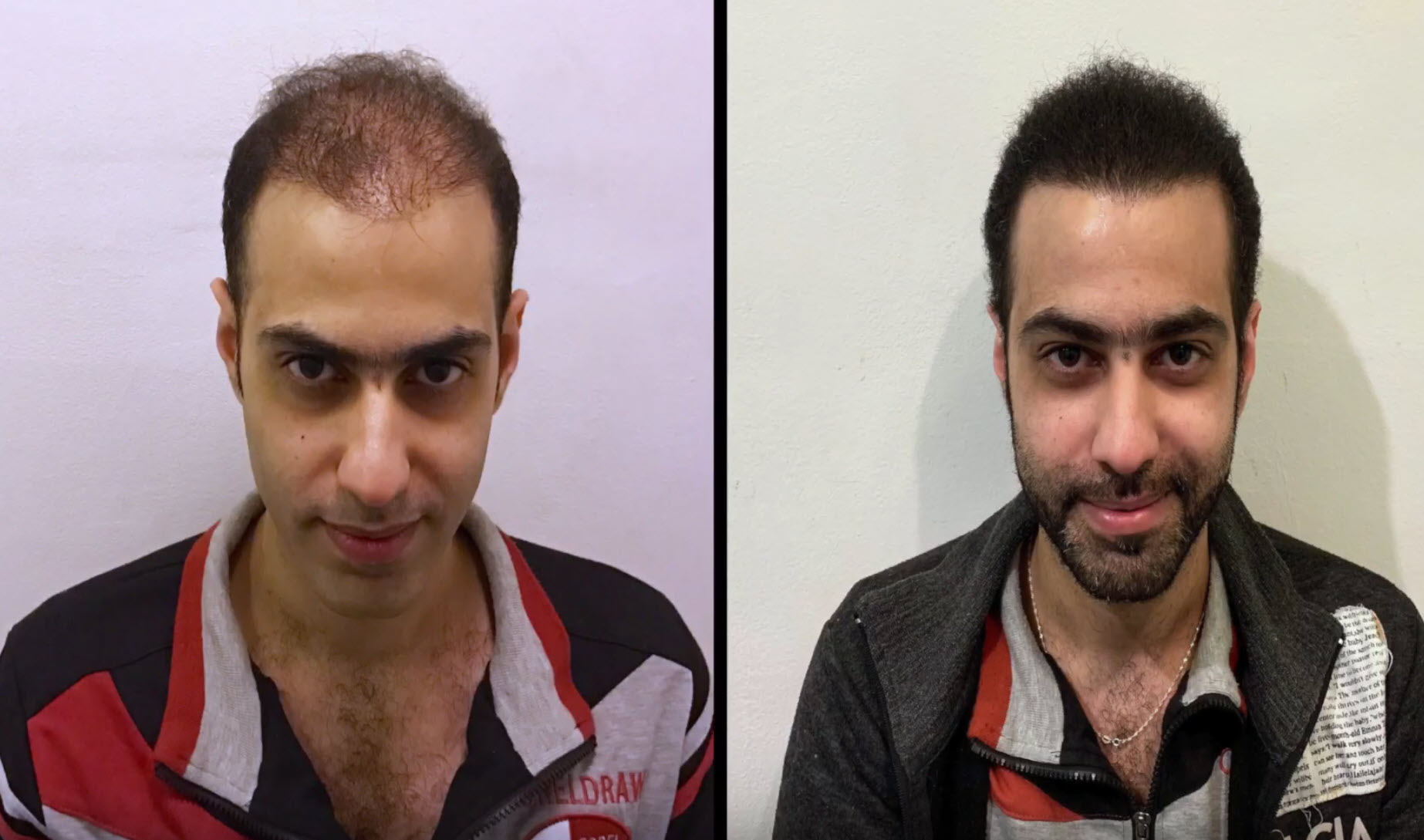 Patient Shares Story of Bad Hair Transplant In Turkey - Fight the Fight