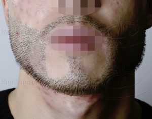 Botched Beard Hair Transplant & Repair - Fight the Fight